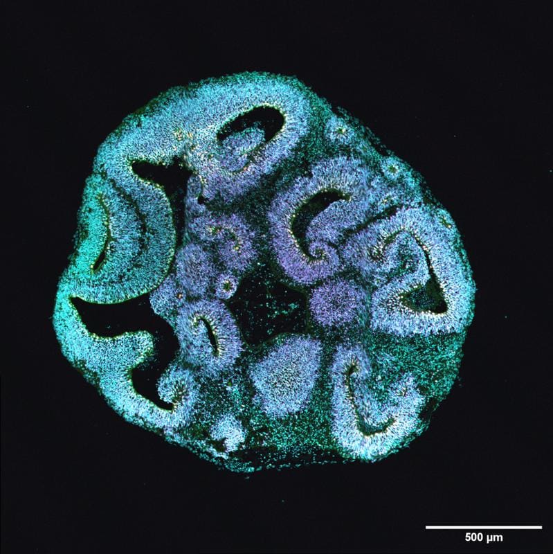 Brain organoids clarify the causes of rare developmental disorders ...